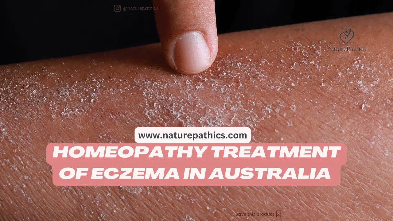 Buy best homeopathy medicine for Eczema, Rashes | Homeopathy Online